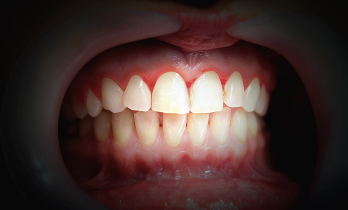 Gingivitis Treatment | Beyond Dental Health